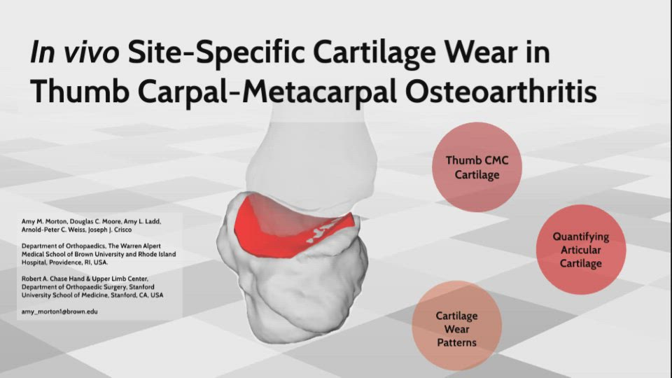 In-vivo Site-Specific Cartilage Wear in Thumb Carpal-Metacarpal ...